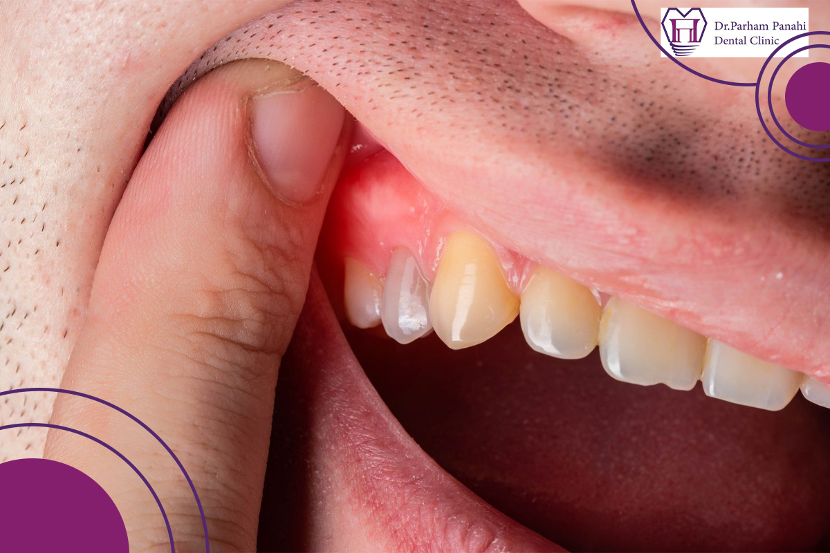 علل و درمان کبودی لثه (سیاهی لثه) - دکتر پرهام پناهی